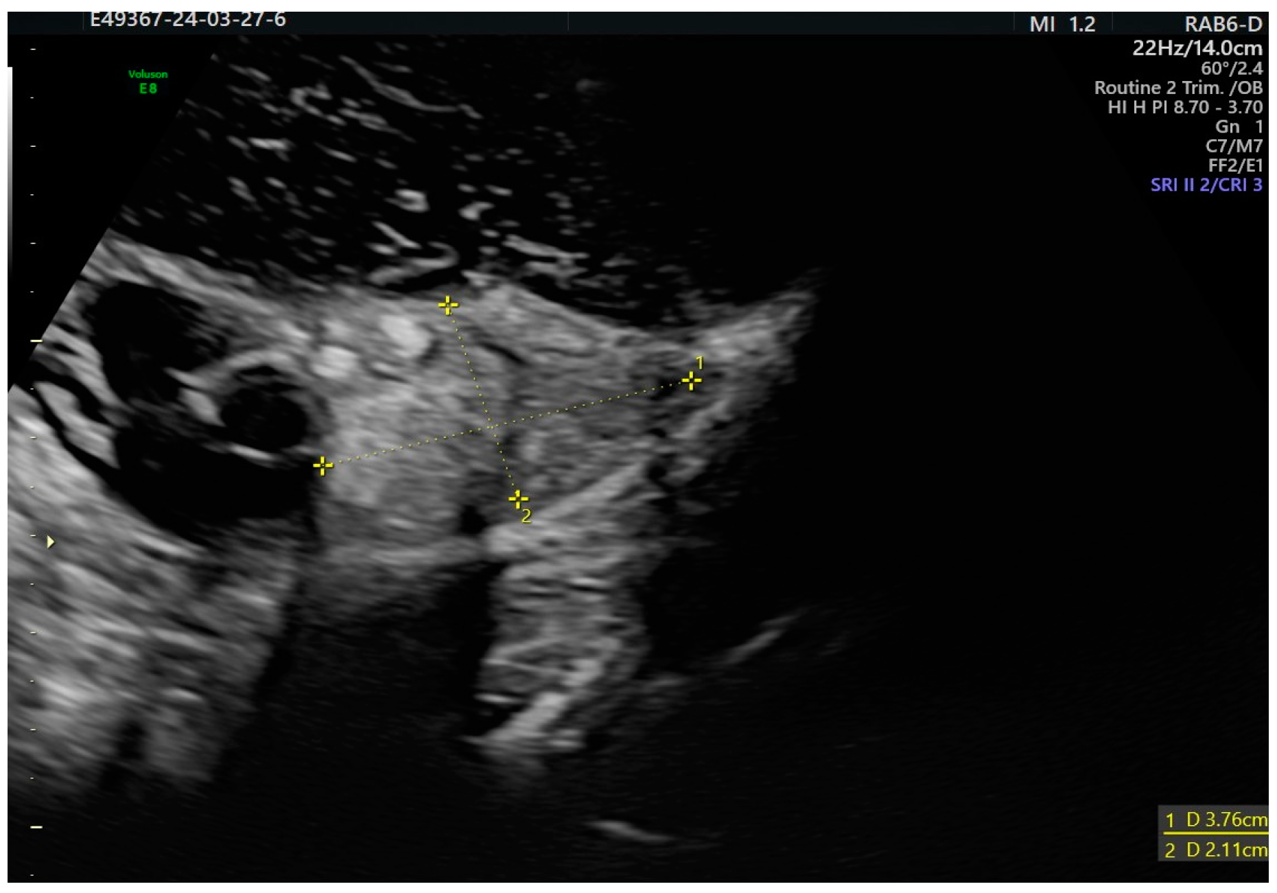 Struma Ovarii during Pregnancy