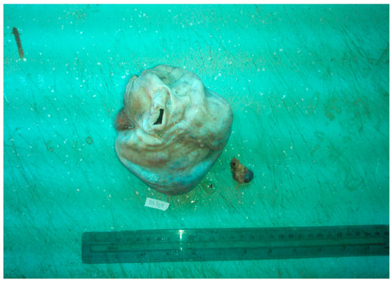 Struma Ovarii during Pregnancy