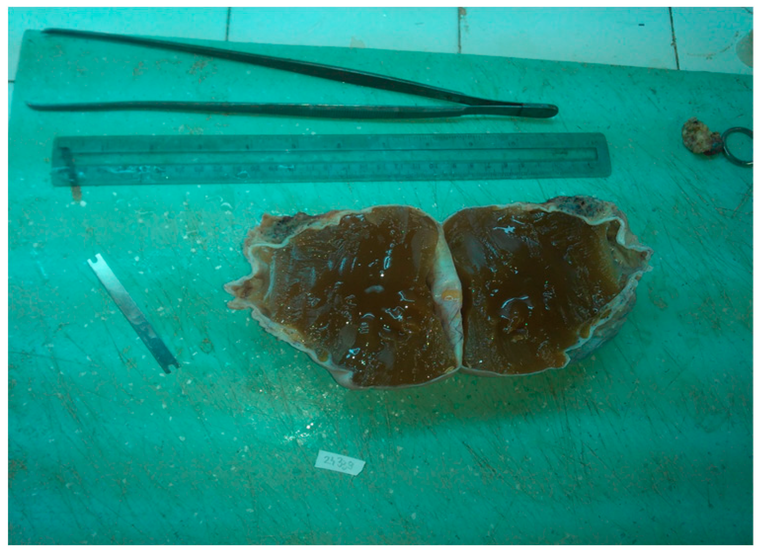 Struma Ovarii during Pregnancy