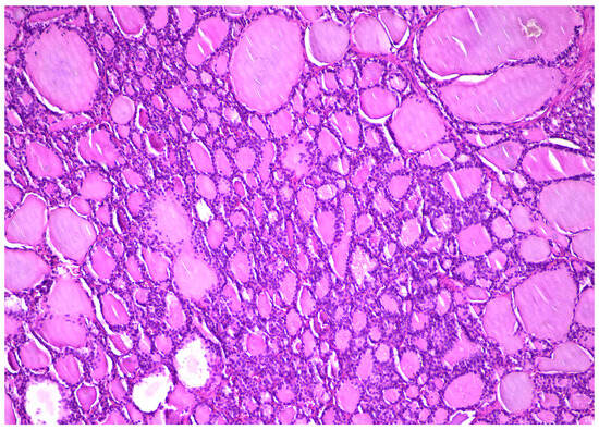 Struma Ovarii during Pregnancy