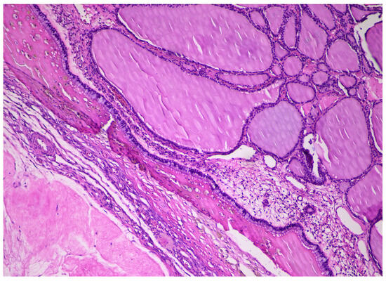 Struma Ovarii during Pregnancy