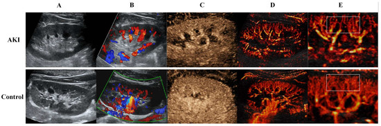 Value of Ultrasound Super-Resolution Imaging for the Assessment of ...