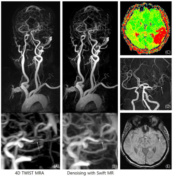 Deep Learning-Based High-Resolution Magnetic Resonance Angiography (MRA ...