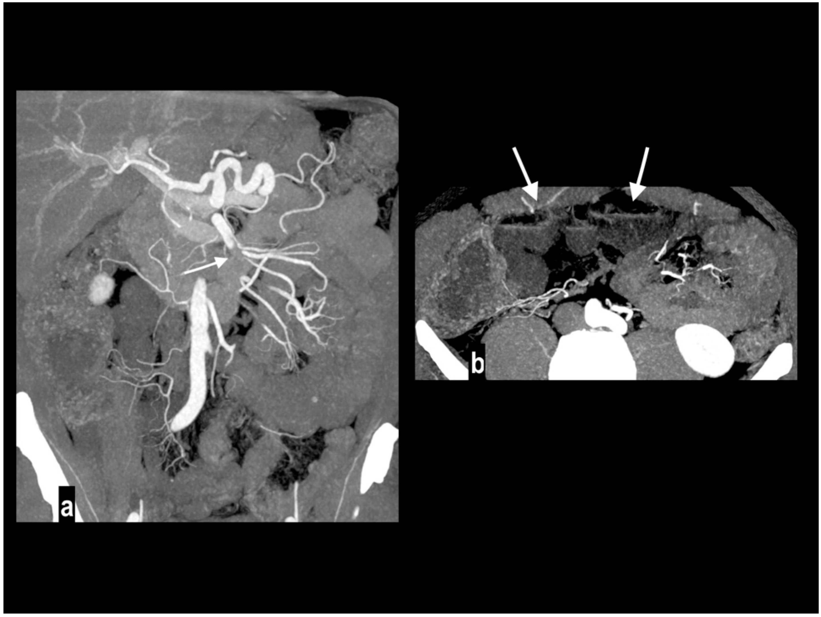 Diagnostic Role of Multi-Detector Computed Tomography in Acute ...