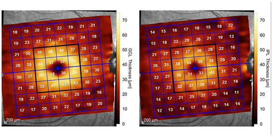 Macular OCT’s Proficiency in Identifying Retrochiasmal Visual Pathway ...