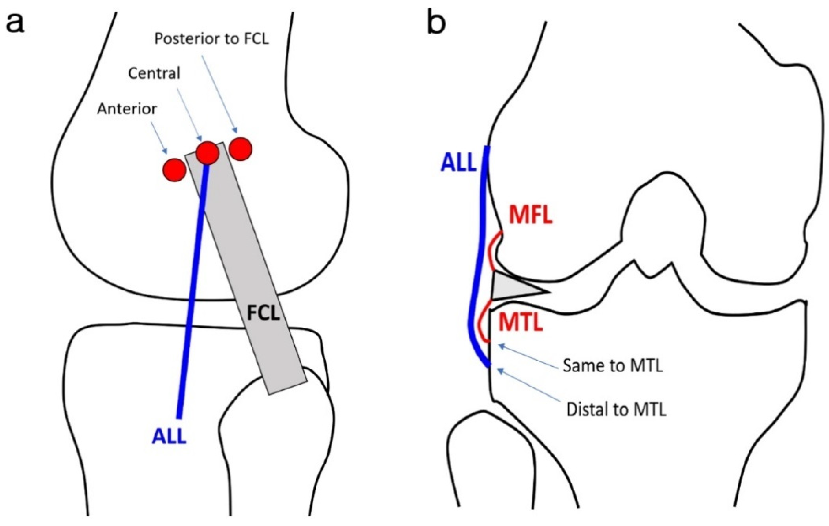 Magnetic Resonance Imaging Features of Anterolateral Ligament in Young ...