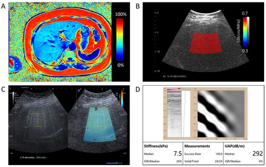 Application of Quantitative Ultrasonography and Artificial Intelligence ...