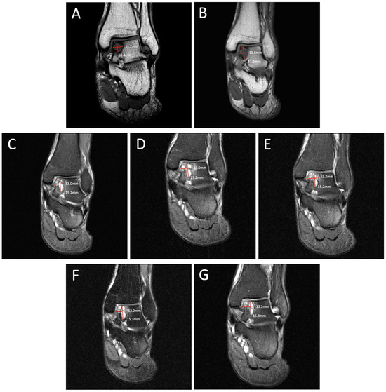 Twelve-Year Progression of Osteochondral Lesions of the Talus Observed Using Magnetic Resonance ...