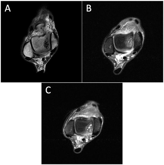 Twelve-Year Progression of Osteochondral Lesions of the Talus Observed ...