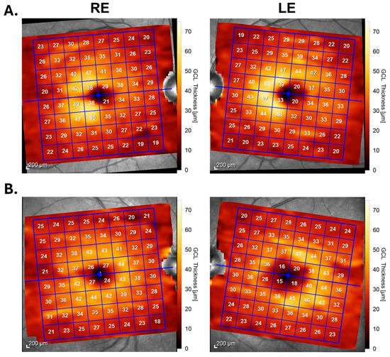 Homonymous Hemiatrophy of Macular Ganglion Cell Layer as a Marker of ...