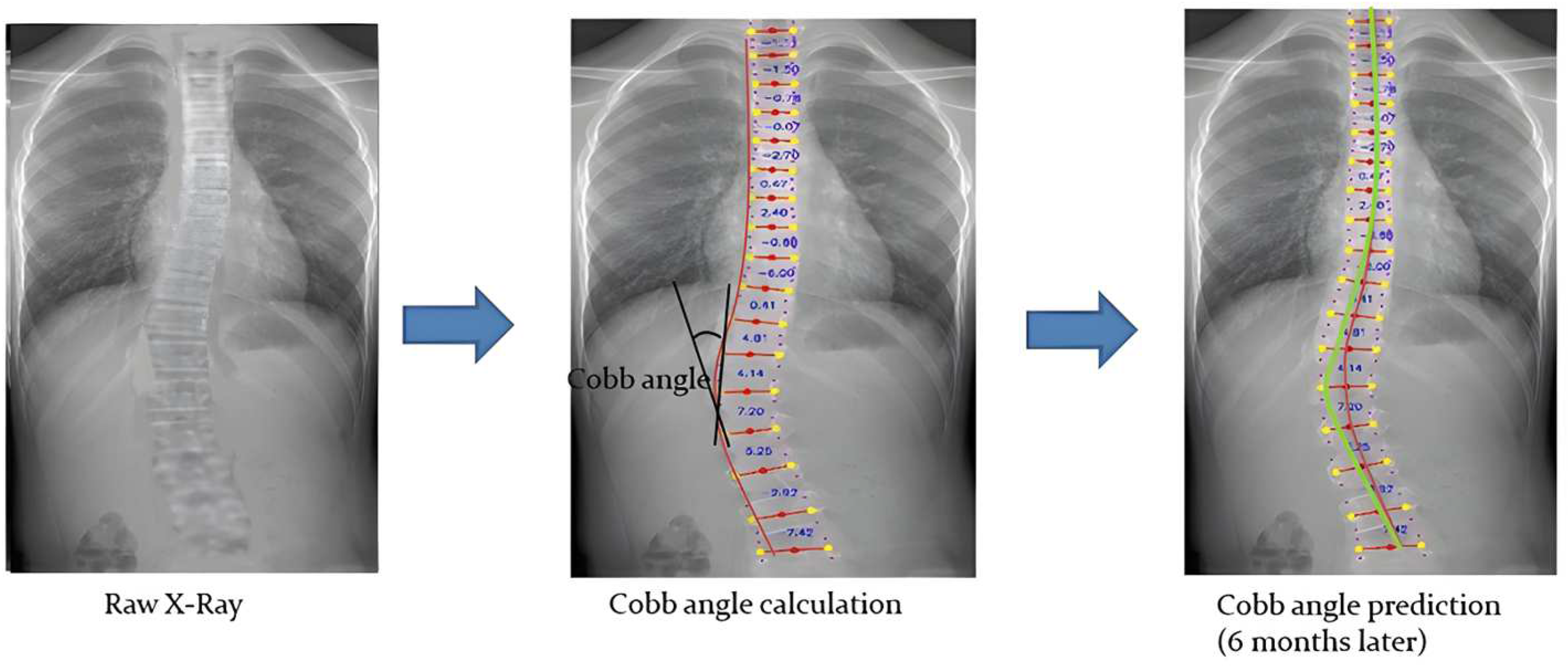 Deep Learning-Based Prediction Model for the Cobb Angle in Adolescent Idiopathic Scoliosis Patients