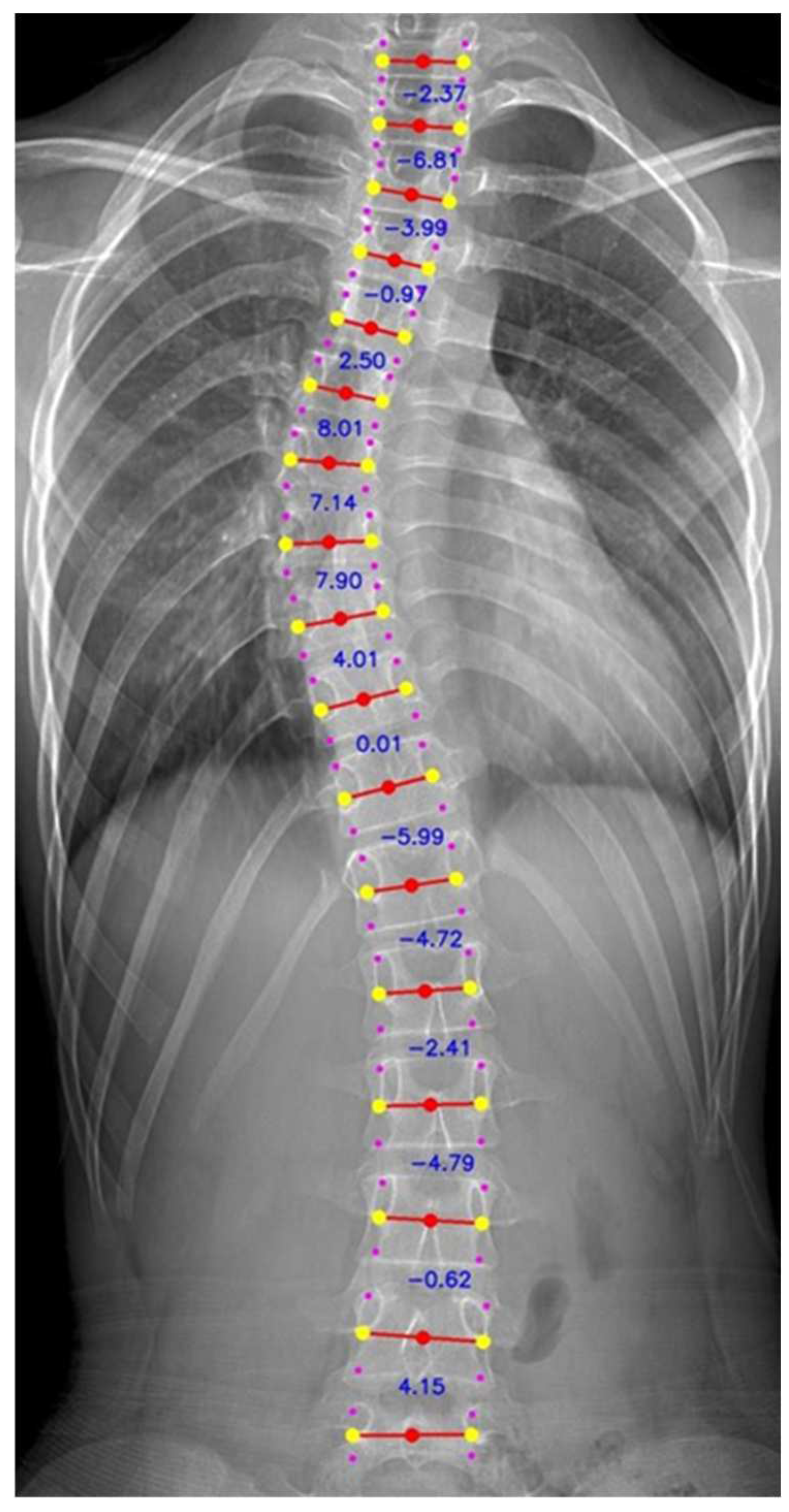 Deep Learning-Based Prediction Model for the Cobb Angle in Adolescent Idiopathic Scoliosis Patients