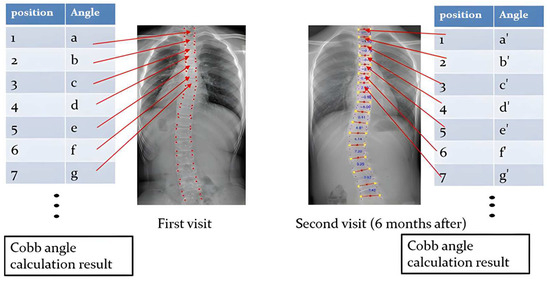 Deep Learning-Based Prediction Model for the Cobb Angle in Adolescent ...