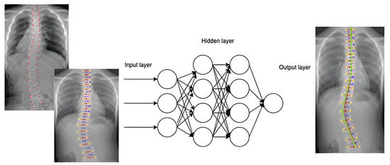 Deep Learning-Based Prediction Model for the Cobb Angle in Adolescent Idiopathic Scoliosis Patients