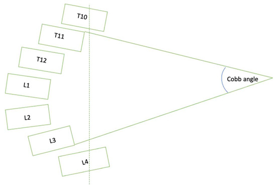 Deep Learning-Based Prediction Model for the Cobb Angle in Adolescent ...