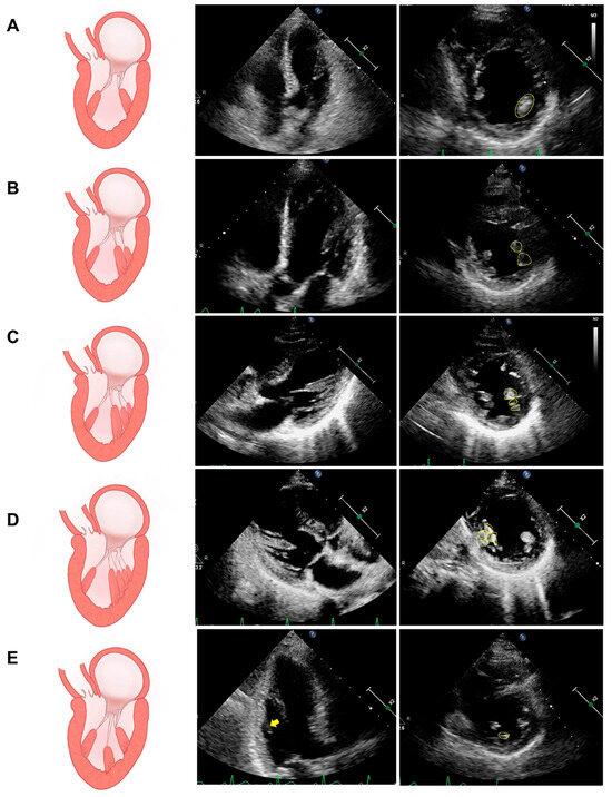 Left Ventricular Papillary Muscle: Anatomy, Pathophysiology, and ...