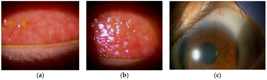 A Case of Refractory Vernal Keratoconjunctivitis Showing Improvement ...