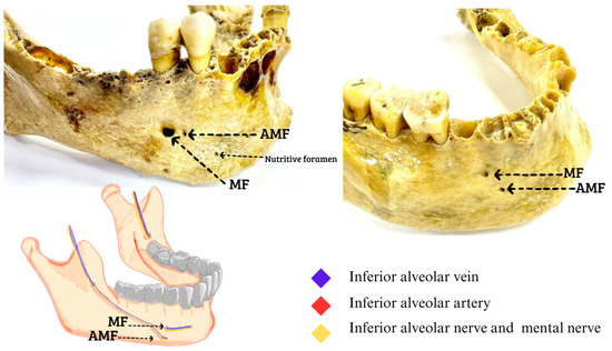 Morphological Characteristics of the Double Mental Foramen and Its Relevance in Clinical ...