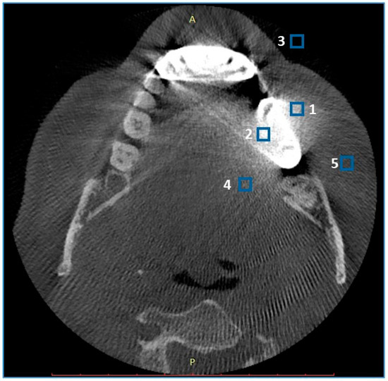 The Impact of AI on Metal Artifacts in CBCT Oral Cavity Imaging