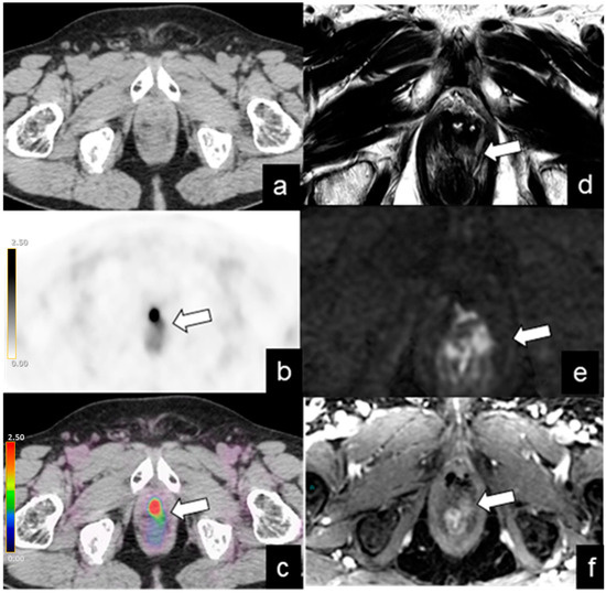 68Ga-PSMA PET/CT in Recurrent Prostate Cancer after Radical ...
