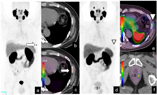68Ga-PSMA PET/CT in Recurrent Prostate Cancer after Radical ...