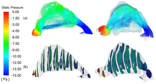 Nasal Airflow Dynamics following LeFort I Advancement in Cleft Nasal ...