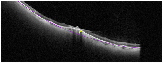Involvement of Sclera in Lattice Retinal Degeneration: An Optical ...