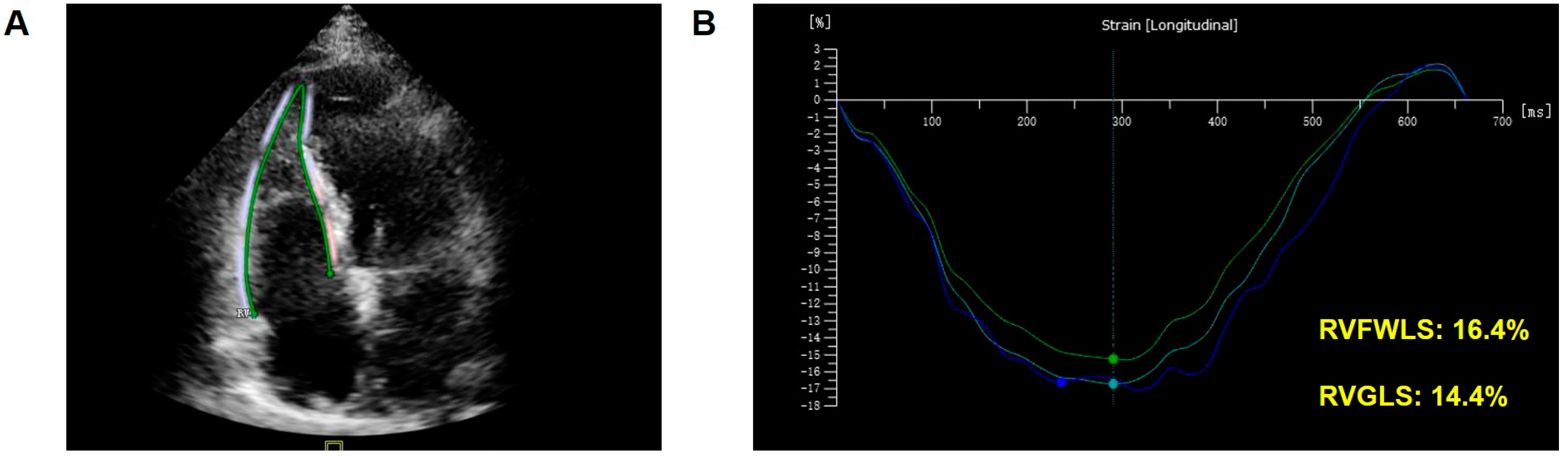 Speckle-Tracking Echocardiography in Right Ventricular Function of ...
