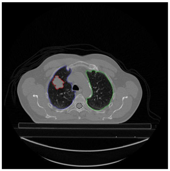 Diagnostics | Free Full-Text | Enhancing Lung Cancer Survival Prediction: 3D CNN Analysis of CT ...