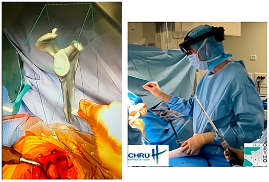 Emerging Innovations in Preoperative Planning and Motion Analysis in ...