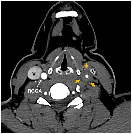 Central Retinal Artery Occlusion Associated with Takayasu Arteritis