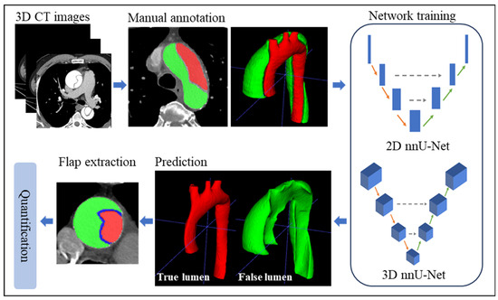 Diagnostics | Free Full-Text | Automatic Segmentation of Type A Aortic Dissection on Computed ...