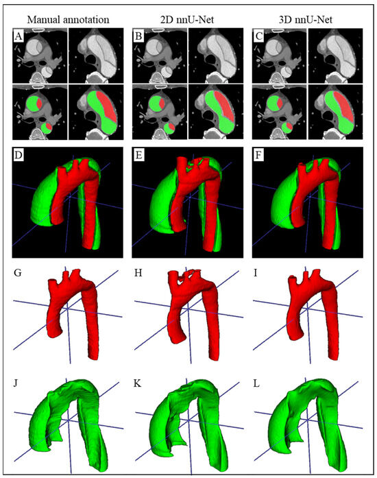 Diagnostics | Free Full-Text | Automatic Segmentation of Type A Aortic Dissection on Computed ...