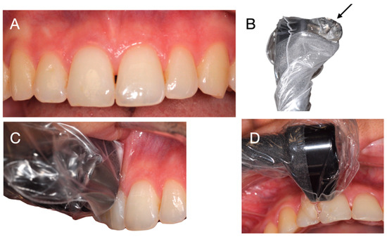 Intraoral Ultrasonography for the Exploration of Periodontal Tissues: A ...