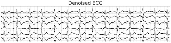 AI-Driven Real-Time Classification of ECG Signals for Cardiac Monitoring Using i-AlexNet ...