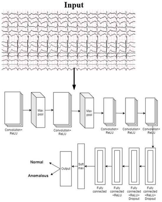 AI-Driven Real-Time Classification of ECG Signals for Cardiac ...
