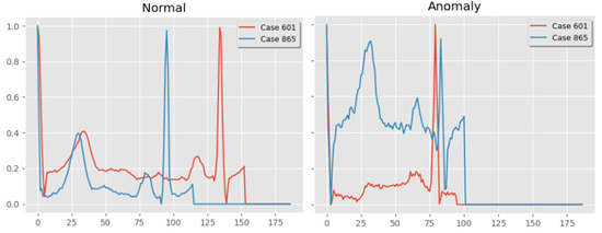 AI-Driven Real-Time Classification of ECG Signals for Cardiac ...