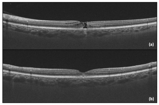 High-Resolution Imaging in Macular Telangiectasia Type 2: Case Series ...