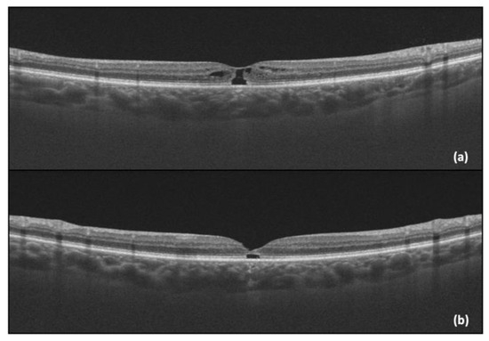 High-Resolution Imaging in Macular Telangiectasia Type 2: Case Series ...