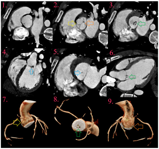 Imaging in Infective Endocarditis—Current Opinions and Trends in ...