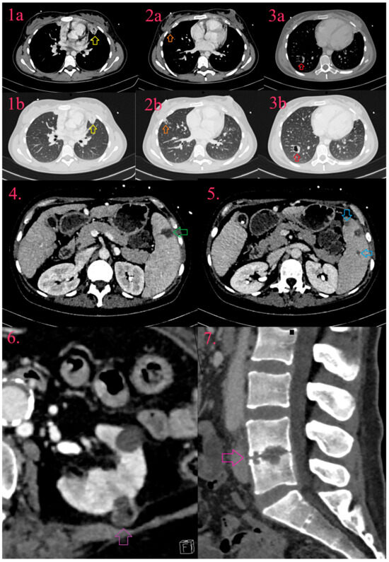 Imaging in Infective Endocarditis—Current Opinions and Trends in ...