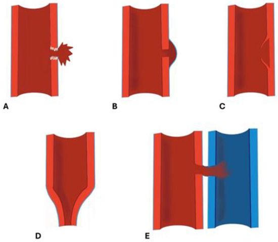 CTA Imaging of Peripheral Arterial Injuries