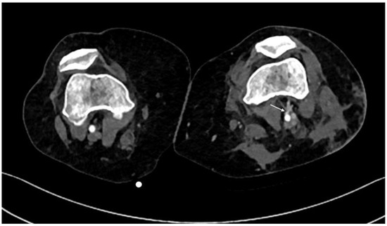 CTA Imaging of Peripheral Arterial Injuries