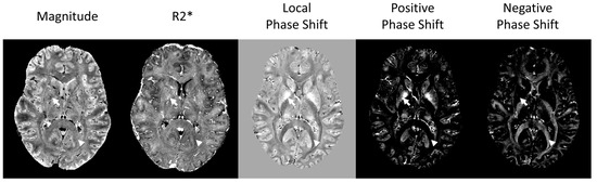 Central Vein Sign and Paramagnetic Rim Lesions: Susceptibility Changes ...