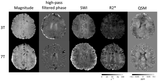 Central Vein Sign and Paramagnetic Rim Lesions: Susceptibility Changes ...