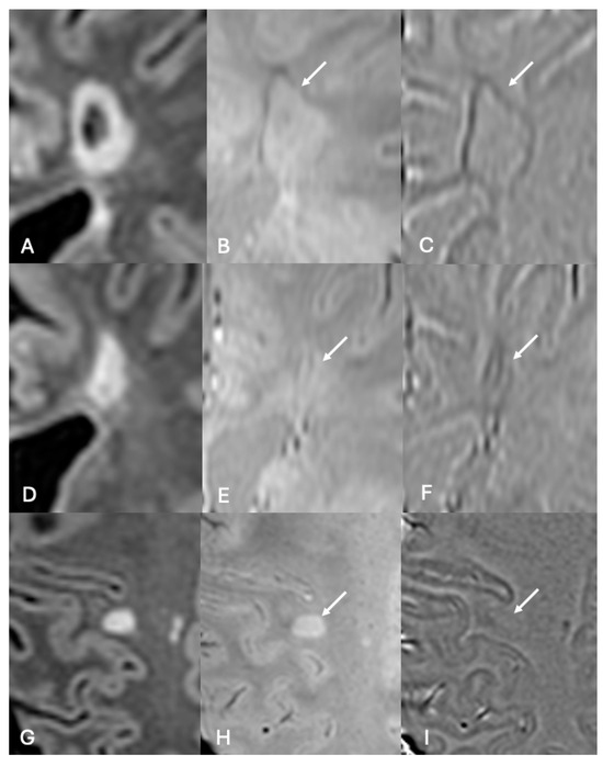 Central Vein Sign and Paramagnetic Rim Lesions: Susceptibility Changes ...