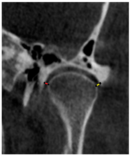 Pre- and Post-Operative Cone Beam Computed Tomography Assessment of the ...