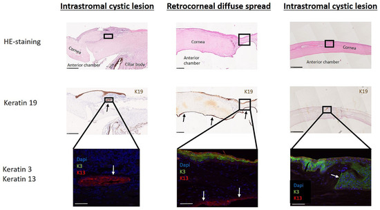 Intraocular Epithelial Ingrowth after Traumatic and Surgical Corneal ...