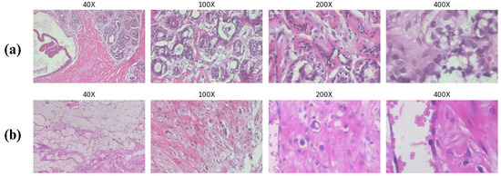 Attention-Based Deep Learning Approach for Breast Cancer ...