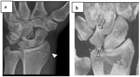 Cone-Beam Computed Tomography (CBCT)-Based Diagnosis of Dental Bone Defects